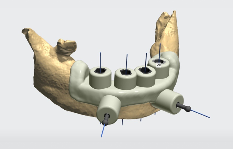 Bone Reduction - Sculpture Studios